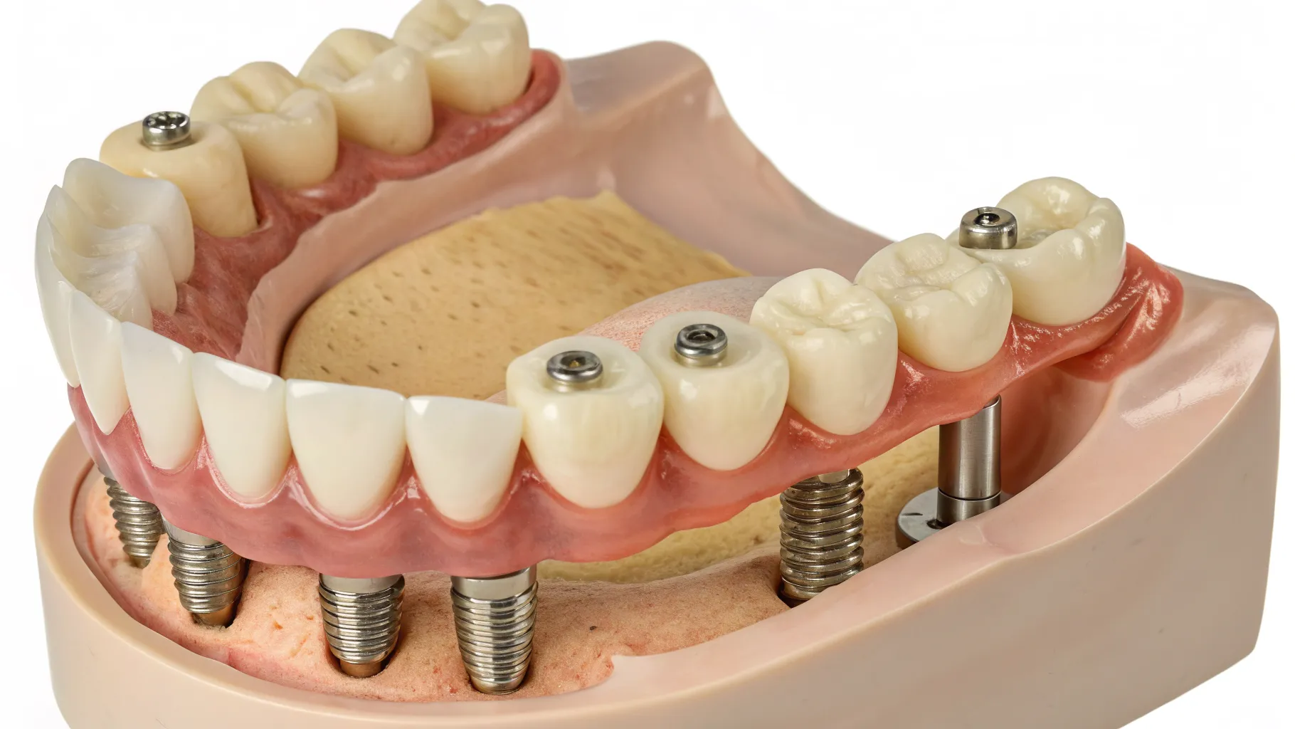 Unlock Your Smile: The Stability of Implant Supported Dentures